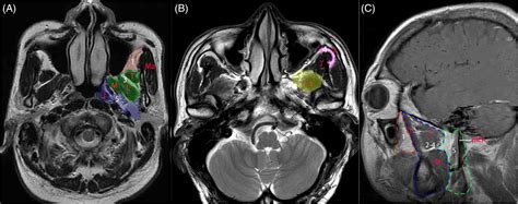 Temporal Fossa And Infratemporal Fossa