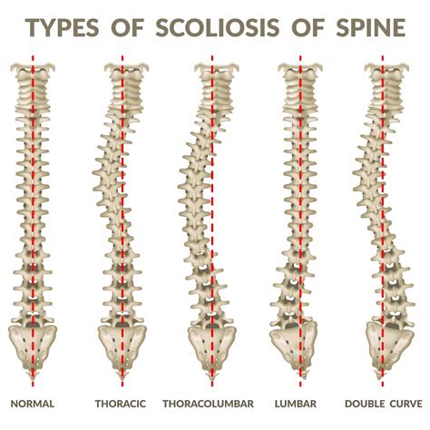 Comprehensive Guide To Understanding Scoliosis Hsrc