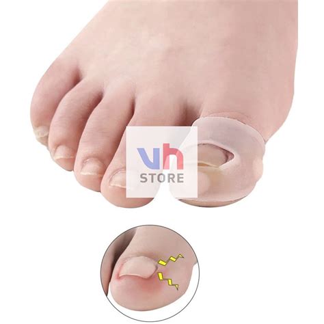 Jual Alat Koreksi Kuku Kaki Tumbuh Ke Dalam Bahan Silikon Elastis