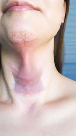 Découvrez les photos choquantes des liposuccions ratées