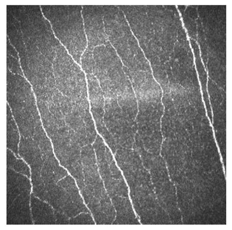 Corneal Confocal Microscopy Imaging Encyclopedia MDPI