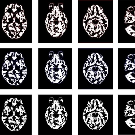 brain mri segmentation based on level set for clustered images by download scientific diagram