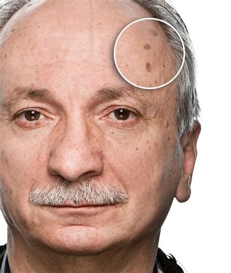 Collection 90 Pictures Seborrheic Keratosis On Face Pictures Updated