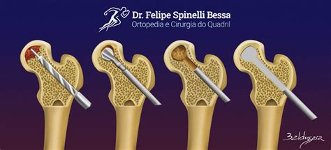 Necrose avascular da cabeça do fêmur Dr Felipe Bessa