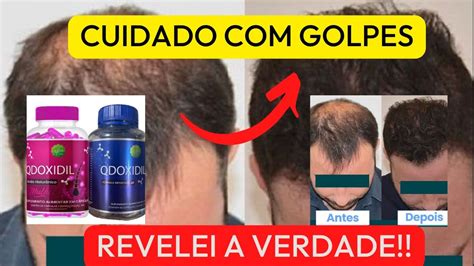 TESTEI O QDOXIDIL E REVELEI TUDO QDoxidil Tratamento Para Queda De