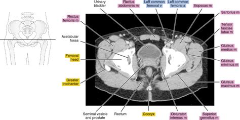 CT Of The Male Pelvis Radiology Key