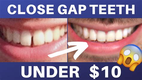 How To Close A Gap In Your Teeth