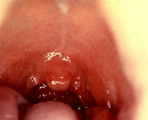 Strep Throat Bacteria Picsninja