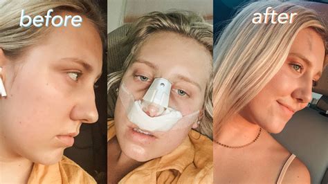 Septoplasty And Turbinate Reduction Before And After