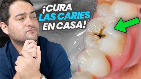 LA VERDAD SOBRE LA CARIES DENTAL Como Curarla En Casa YouTube