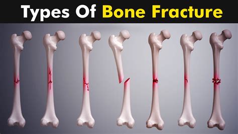 Common Types Of Bone Fracture 3D Animation YouTube