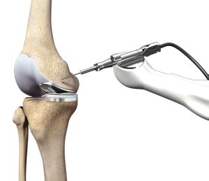 Mako Robotic Assisted Knee Replacement Florida Ortho Care
