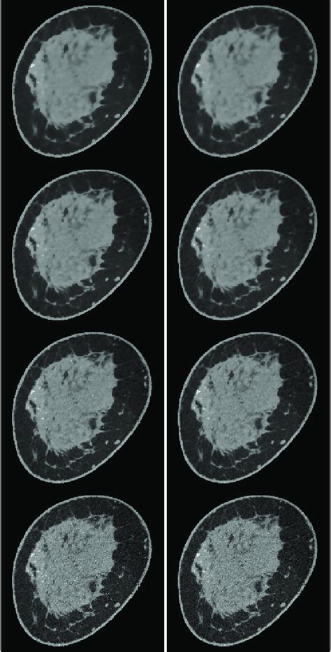 slice images obtained with tpv minimization from breast ct data for download scientific diagram