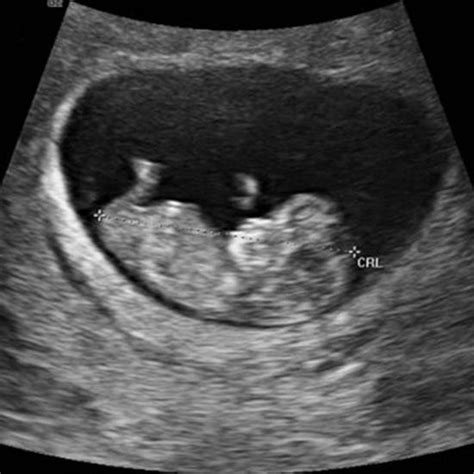 First Trimester Fetal Development Images Of Your Growing Baby