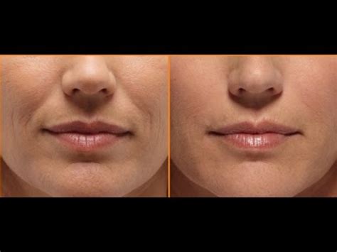 Smooth Out Smile Wrinkles With Face Massage Laugh Wrinkles
