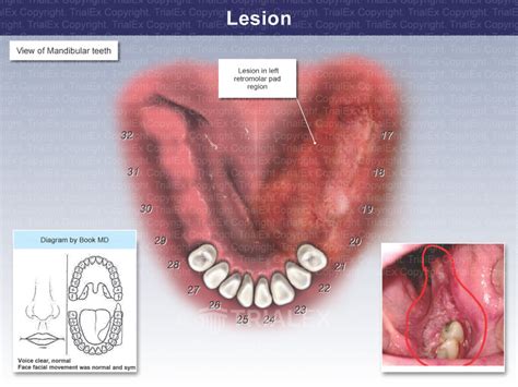 Mandibular Tooth Anatomy Trial Exhibits Off