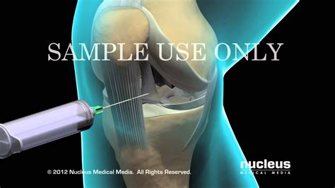 Artroscopia de rodilla menisectomía artroscópica YouTube