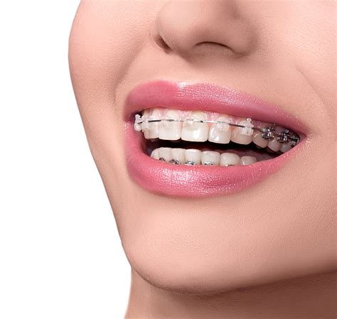 Di Teli Tedavisi Nedir Telvin Dental Zel A Z Ve Di Sa L