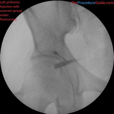 Piriformis Syndrome Injection