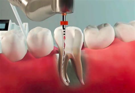 Endodoncja leczenie kanałowe K2dental Stomatolog Gdańsk