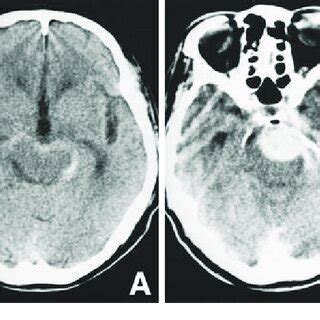 A Computed Tomography CT Scan Showing Subarachnoid Hemorrhage In The