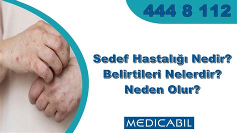 Blog Sedef Hastalığı Nedir Belirtileri Nelerdir Neden Olur