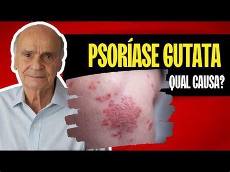 QUAL CAUSA DA PSORÍASE GUTATA SAIBA YouTube