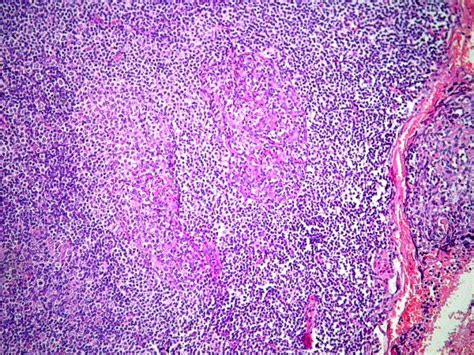 Carcinoma de células escamosas de epiglotis Remedios caseros