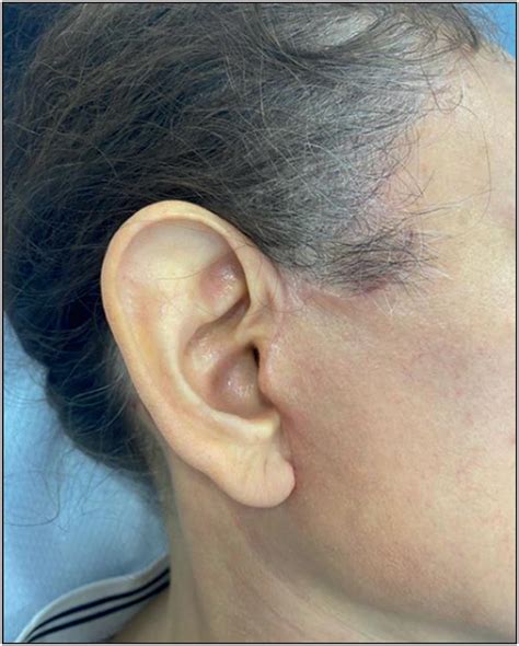 El lifting cervicofacial de plano profundo Presentación de la técnica