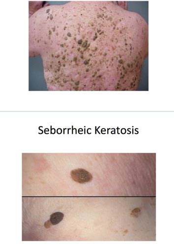 Benign Skin Lesions Flashcards Quizlet