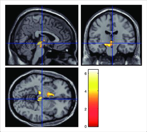 voxel based analysis whole brain voxel based analysis in the migraine download scientific