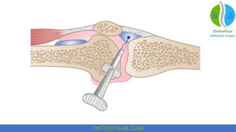 Infrapatellar Bursa Injection Easy Explain OrthoFixar 2024