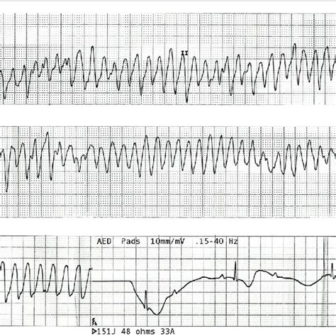 Ecg Shows Polymorphic Ventricular Tachycardia Torsade De Pointes