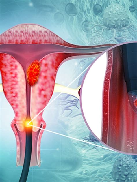 Understanding Cervical Cancer Arab Insightscare