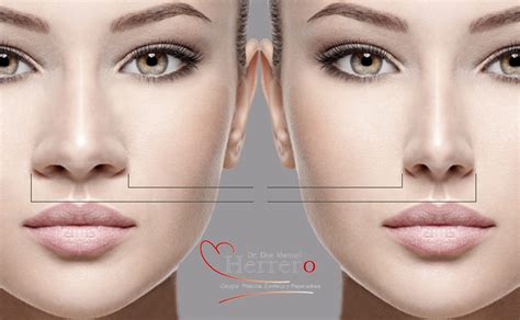 Rinoplastia CLINICA DR MANUEL HERRERO