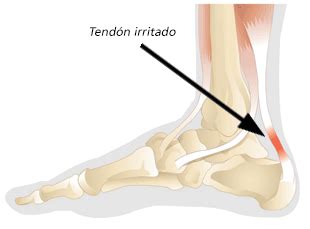 Tendinosis De Aquiles Especialistas En Pie Y Tobillo