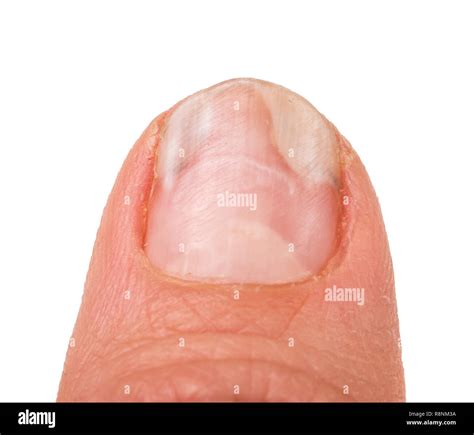 Sintetiza más de 56 imágenes sobre hongos en las uñas de las manos