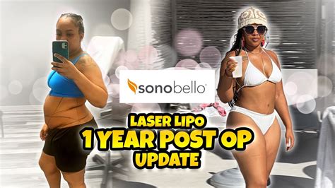 Year Sono Bello Laser Lipo Update Pictures And Cost Included