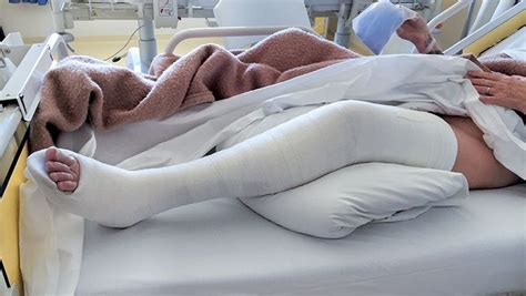 Broken Leg In Bonaire Dan World