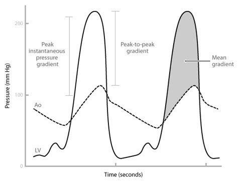 As Aortic Stenosis Echocardiogram