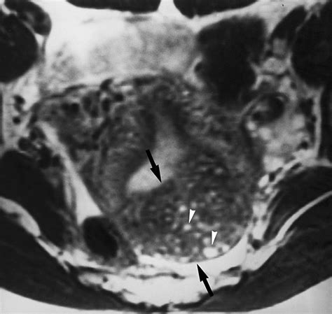 Diffuse And Focal Adenomyosis MR Imaging Findings RadioGraphics