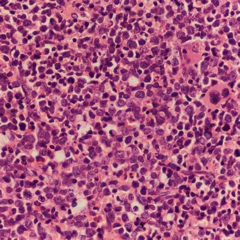 H E Section Of Bone Marrow Biopsy Tissue Showing Hypercellular Marrow