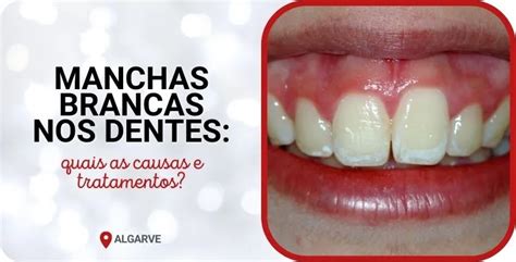Manchas Brancas Nos Dentes Causas E Tratamentos Atelier Do Sorriso