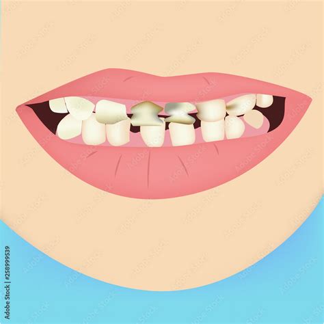 Dental Caries Tooth Decay Caries Infographics Vector Image The Best