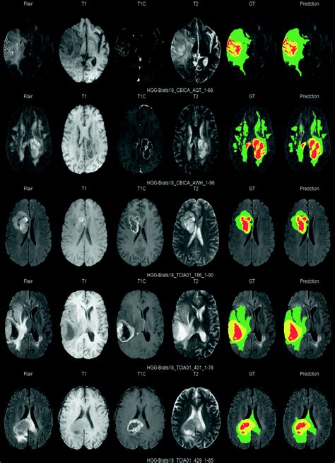 deep convolutional neural networks using u net for automatic brain tumor segmentation in