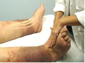 Lymphedema Treatment