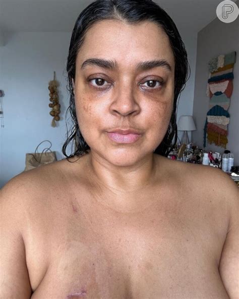 Não tenho vergonha Preta Gil mostra barriga bolsa de ileostomia