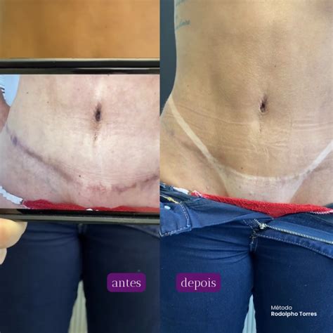 Camuflagem de Cicatrizes Escuras Luciana Lima Saúde e Estética Avançada