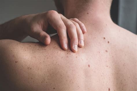 Cancer de la peau qu est ce que la méthode ABCDE infaillible pour