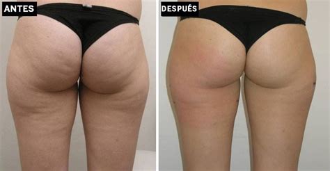 Resultados de la Maderoterapia Fotos Antes y Después